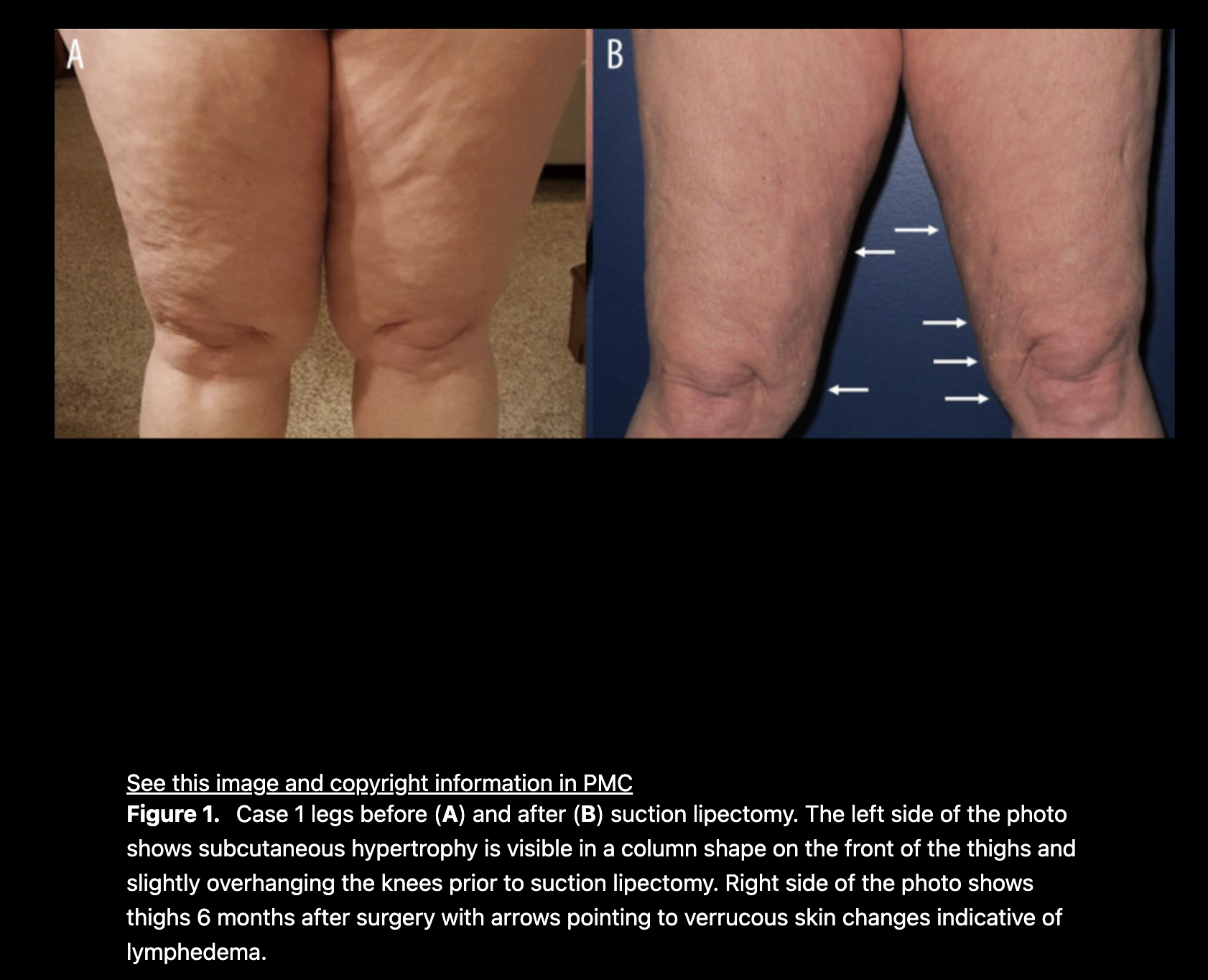 » Lymphatics and Lipedema Surgery - Lipedema