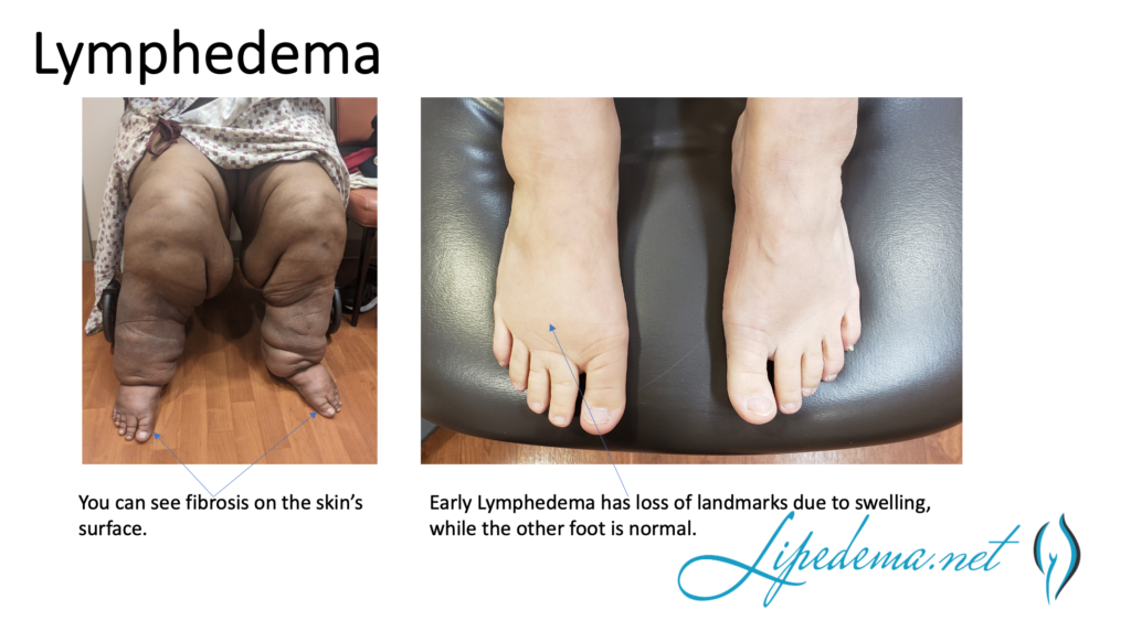 What Is The Difference Between Lipedema And Lymphoedema Treatment