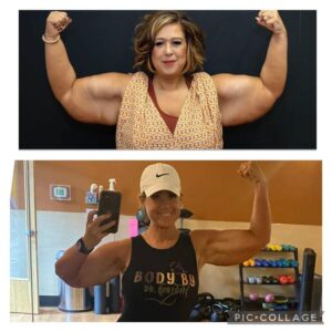 Learn About Lipedema Prevalence in Women | Lipedema