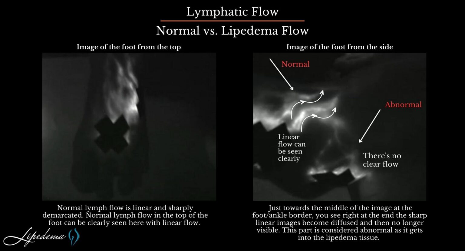 Understanding Lipedema and Lymphatic Flow | Lipedema.net