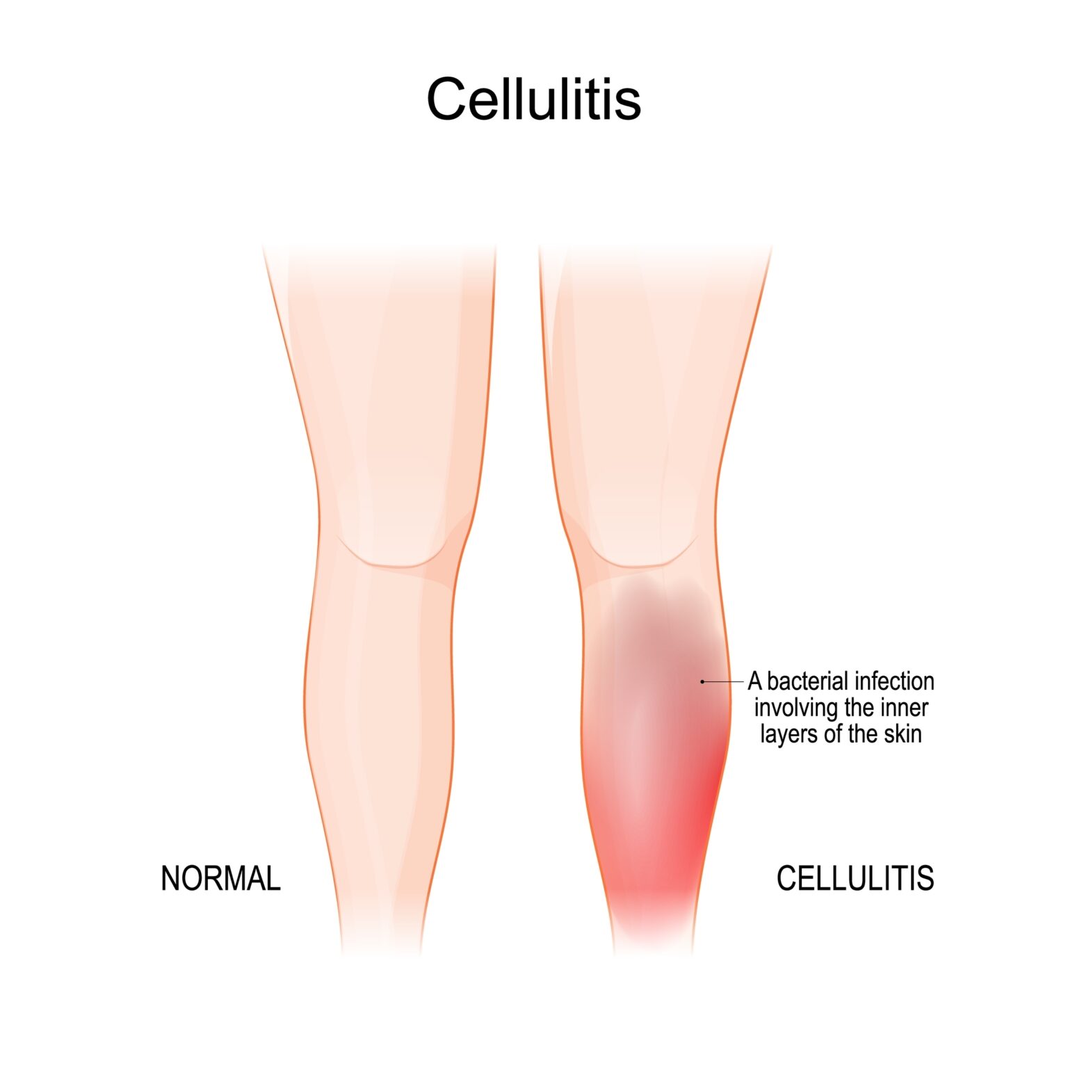 » Lipedema and Cellulitis: Understanding the Relationship and Prevention Strategies - Lipedema