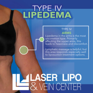 Learn About Stages and Types of Lipedema | Lipedema.net