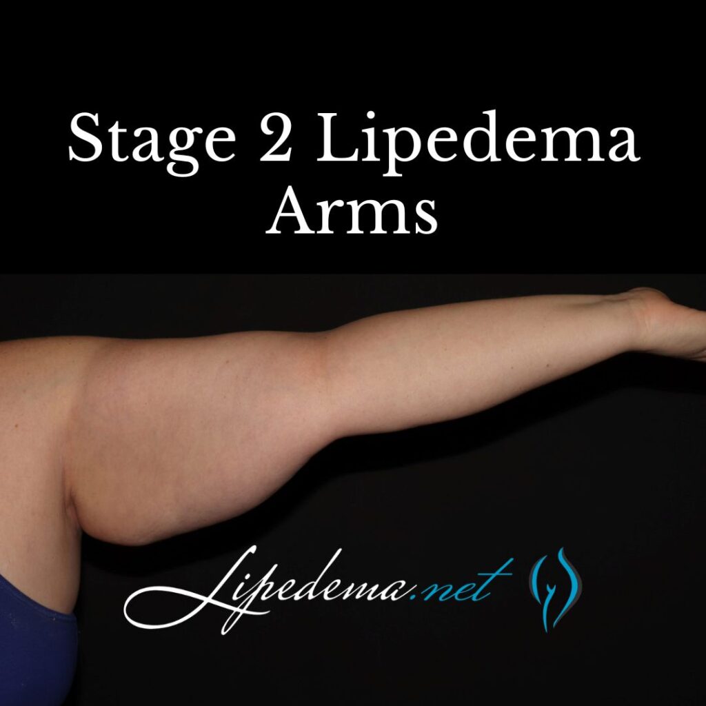 Learn About Stages and Types of Lipedema | Lipedema.net